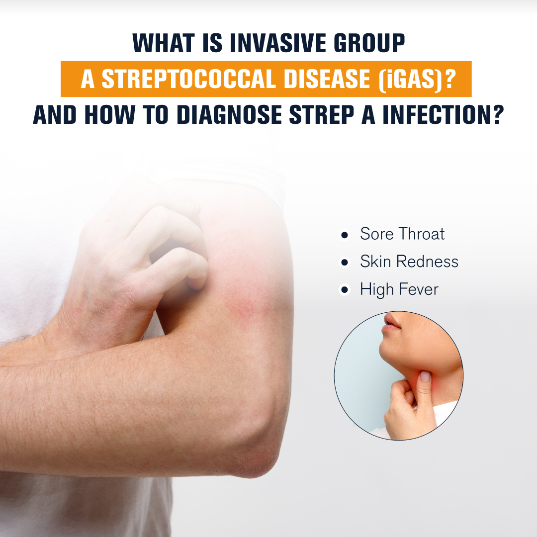What Is Invasive Group A Streptococcal Disease (iGAS) and How to ...