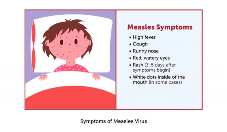 What is Measles Virus and How to Use Measles Virus Rapid Test Kit?
