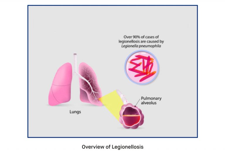What is Legionellosis (Legionnaires' Disease and Pontiac Fever) and How ...