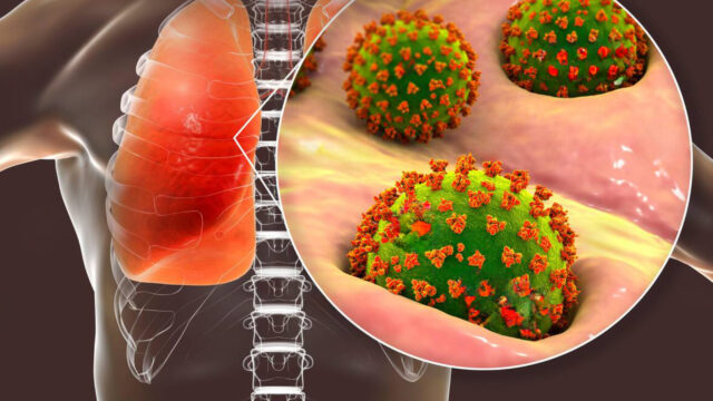 MERS-CoV qPCR Testing in Respiratory Infection Surveillance on 2026